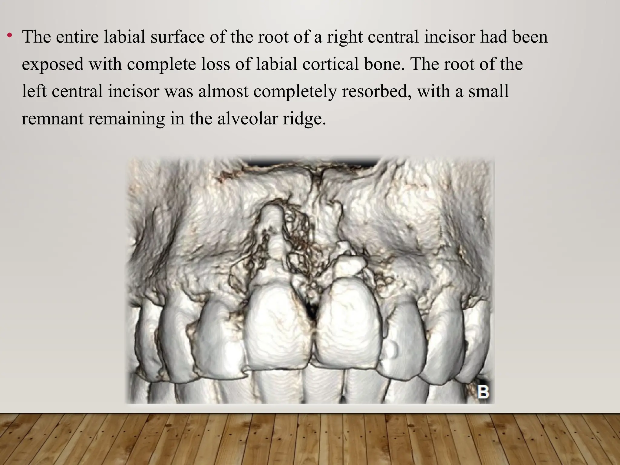 Esthetic rehabilitation of mutilated maxillary anterior alveolar ...