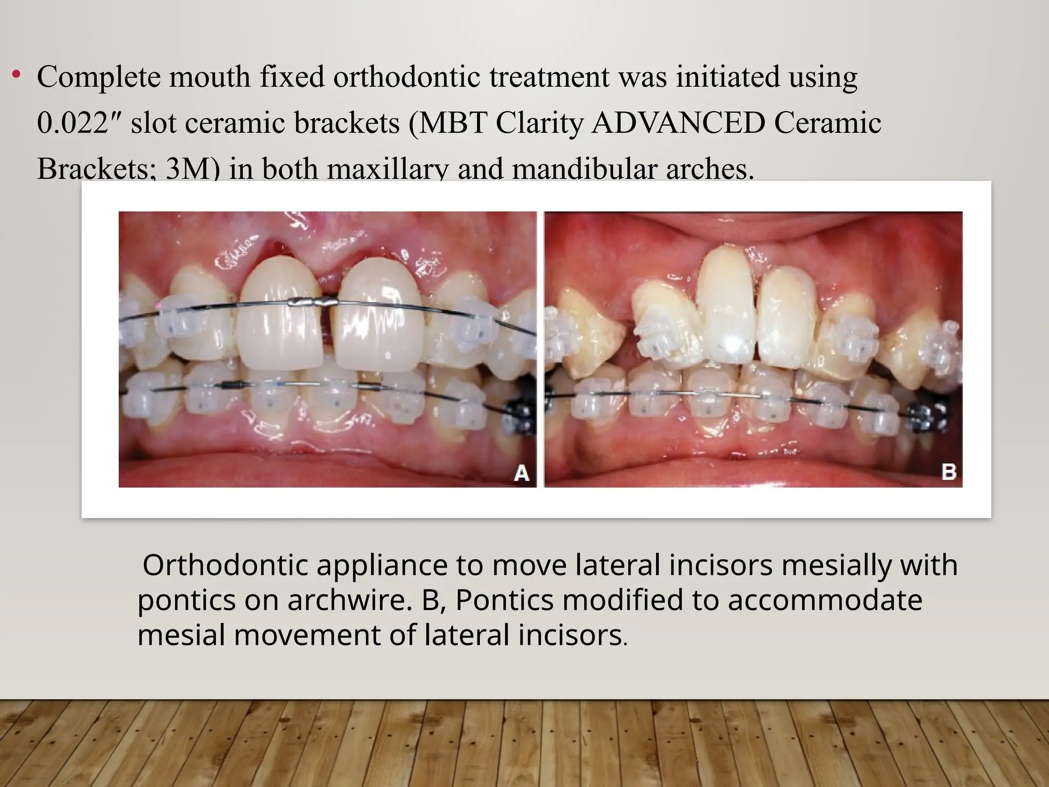 Esthetic rehabilitation of mutilated maxillary anterior alveolar ...