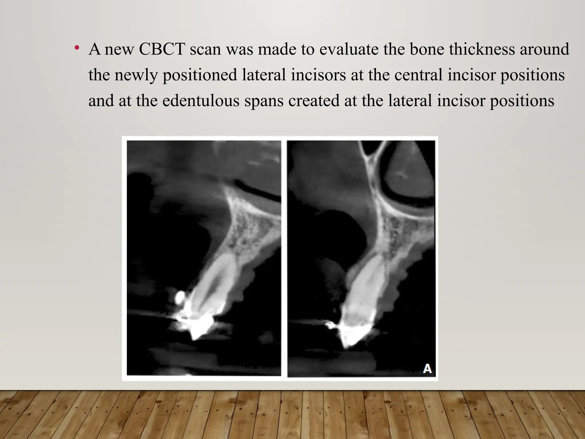 Esthetic rehabilitation of mutilated maxillary anterior alveolar ...
