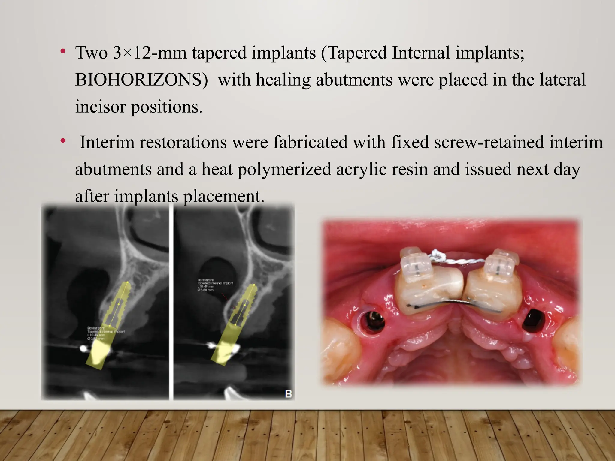 Esthetic rehabilitation of mutilated maxillary anterior alveolar ...