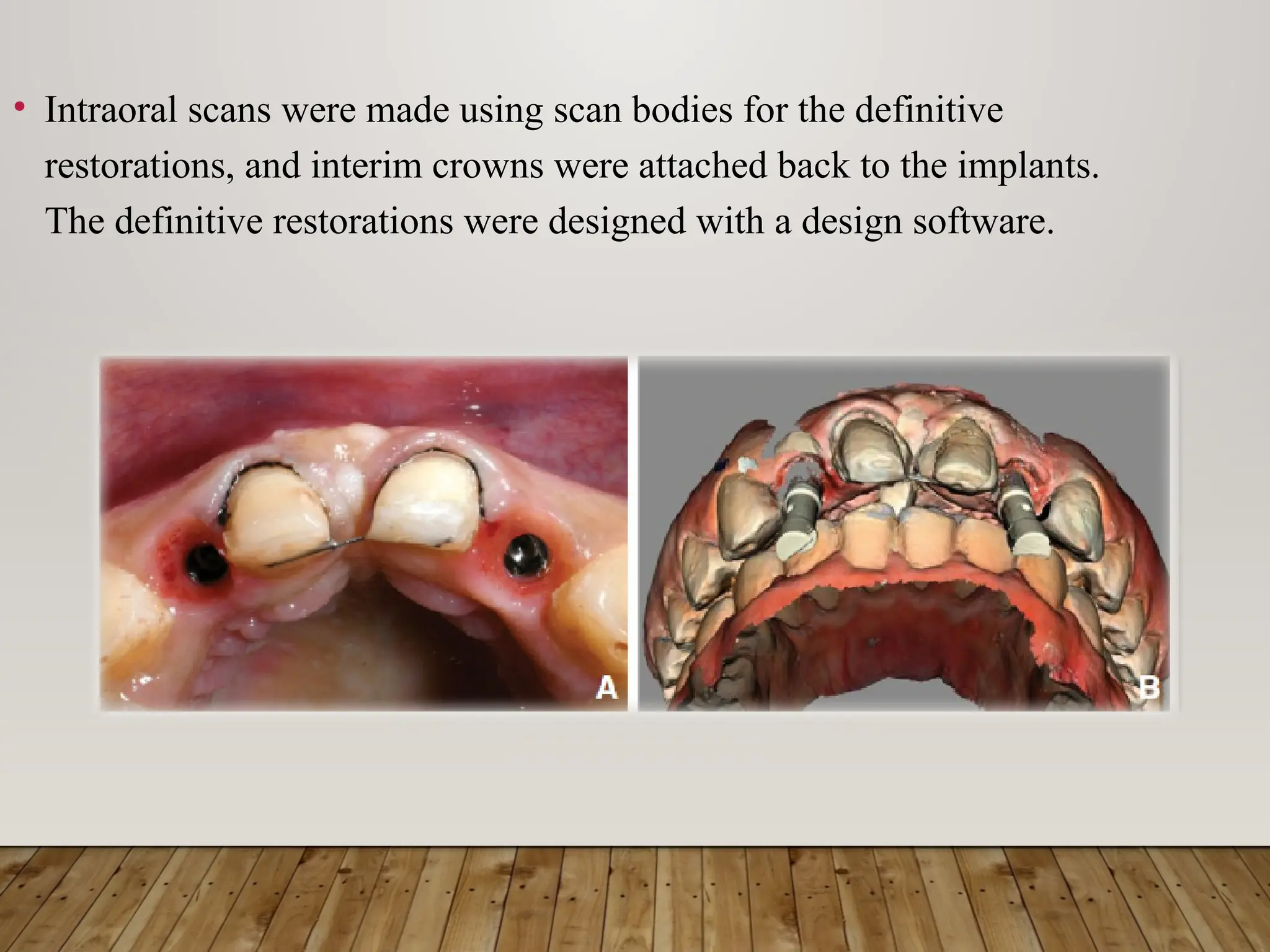 Esthetic rehabilitation of mutilated maxillary anterior alveolar ...