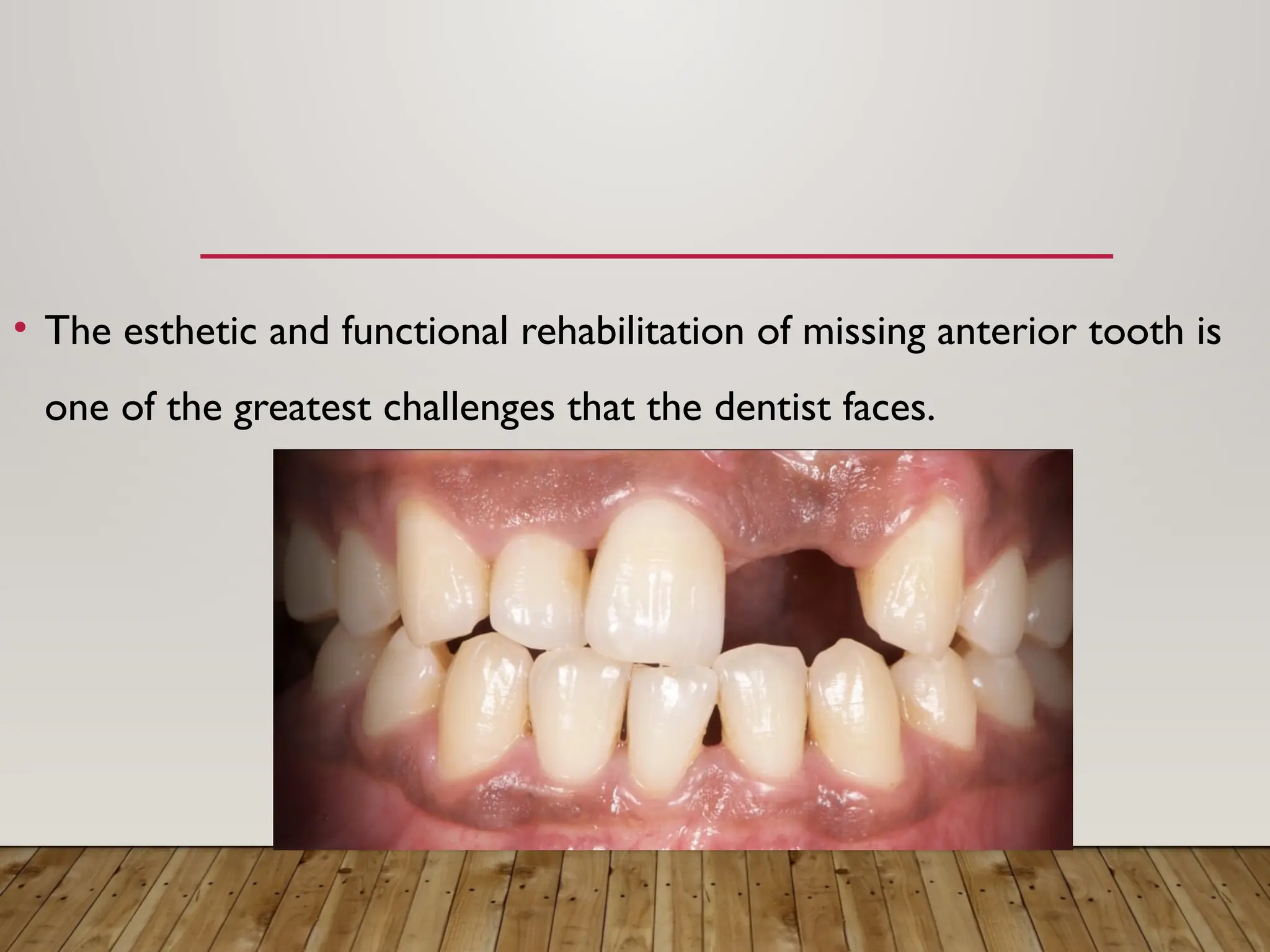 Esthetic rehabilitation of mutilated maxillary anterior alveolar ...