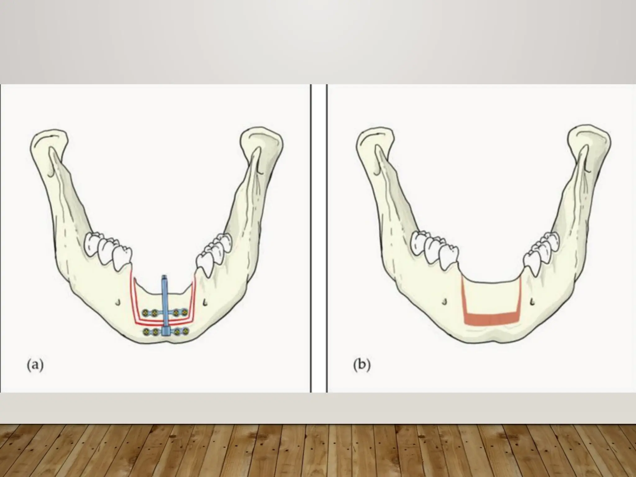 Esthetic rehabilitation of mutilated maxillary anterior alveolar ...