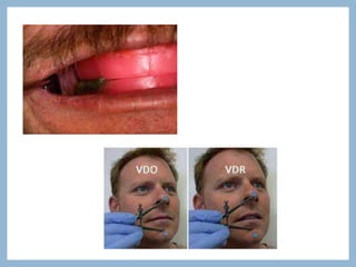 Esthetics in complete dentur.pptx