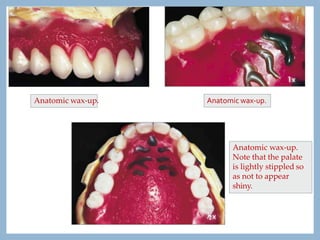 Esthetics in complete dentur.pptx