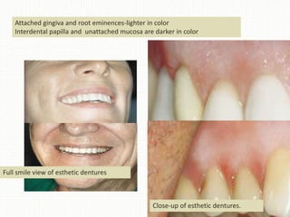 Esthetics in complete dentures dentogenic concept | PPTX