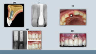 Esthetics in Implant Dentistry | PPTX