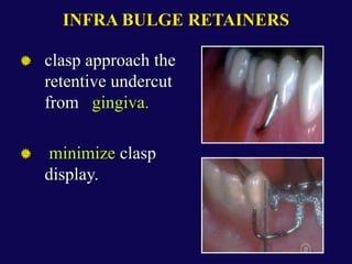 esthetics in RPD.ppt