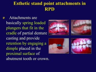esthetics in RPD.ppt