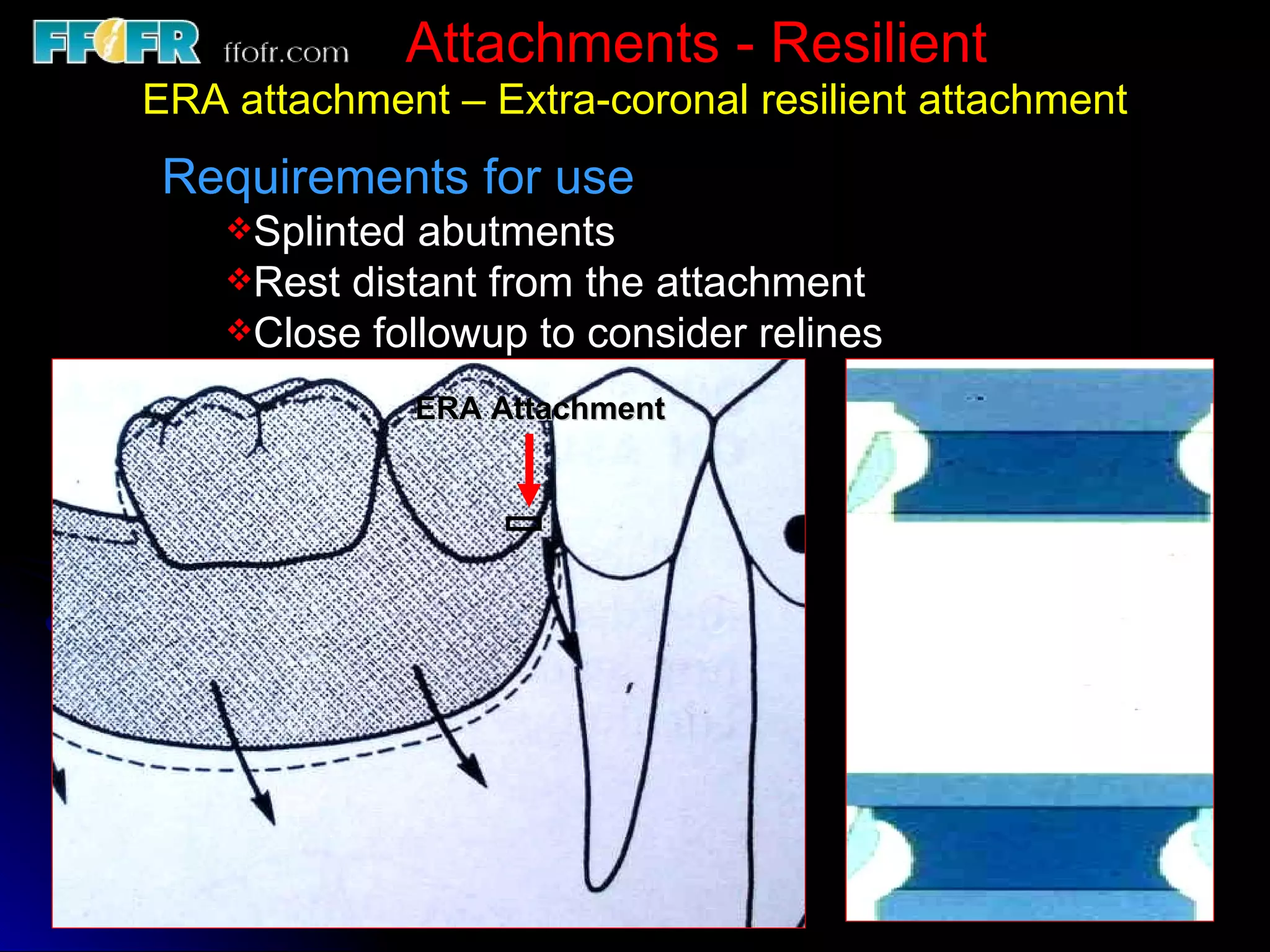 Esthetics, rotational path, attachments | PPT