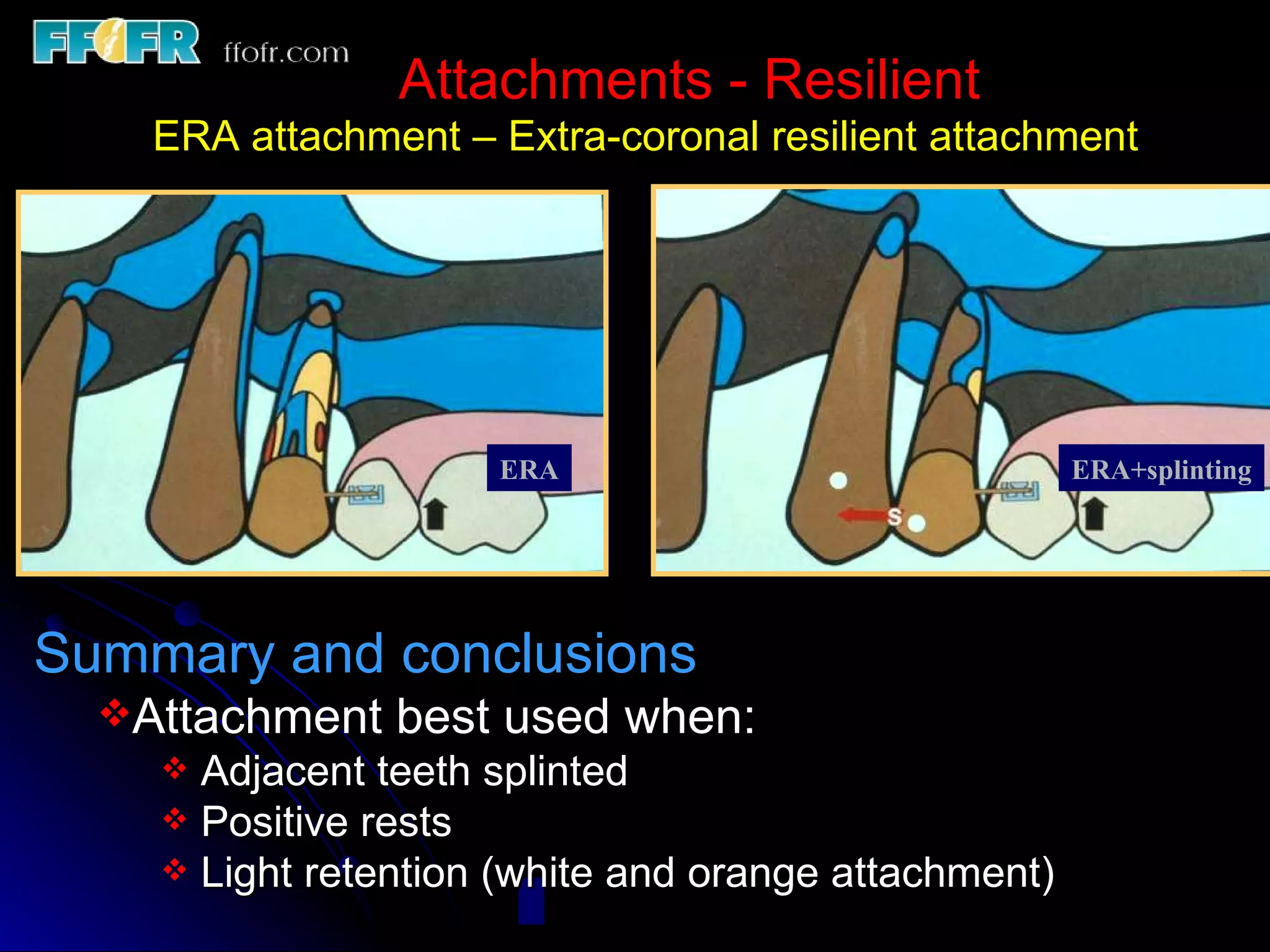 Esthetics, rotational path, attachments | PPT