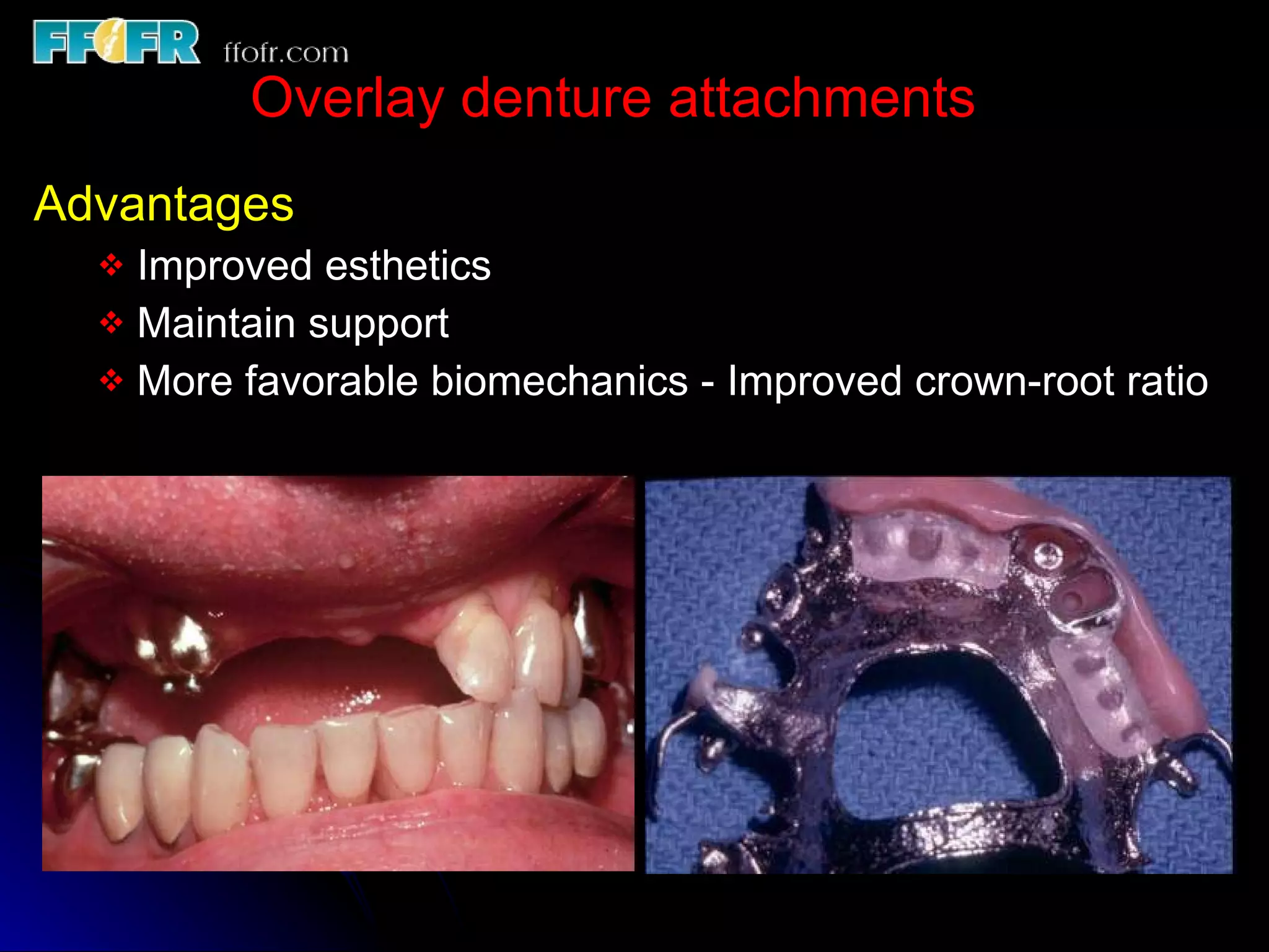 Esthetics, rotational path, attachments | PPT