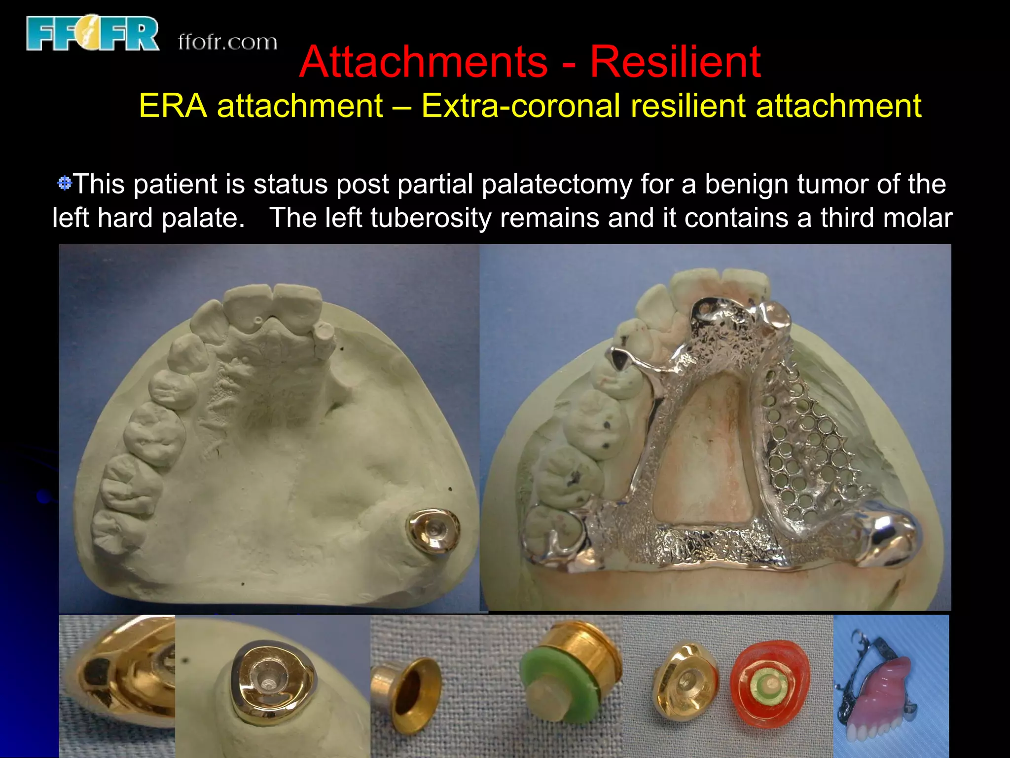 Esthetics, rotational path, attachments | PPT