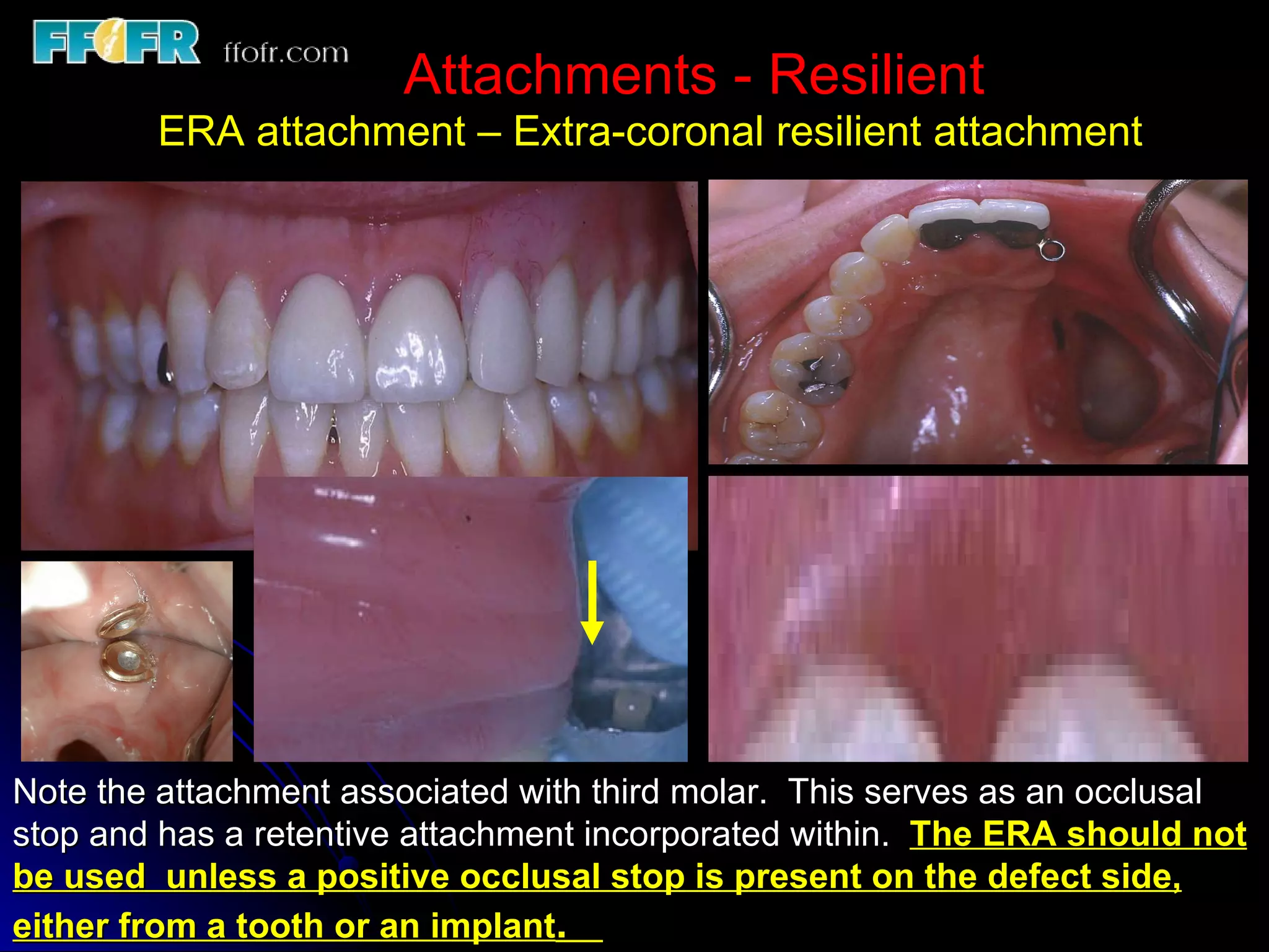Esthetics, rotational path, attachments | PPT