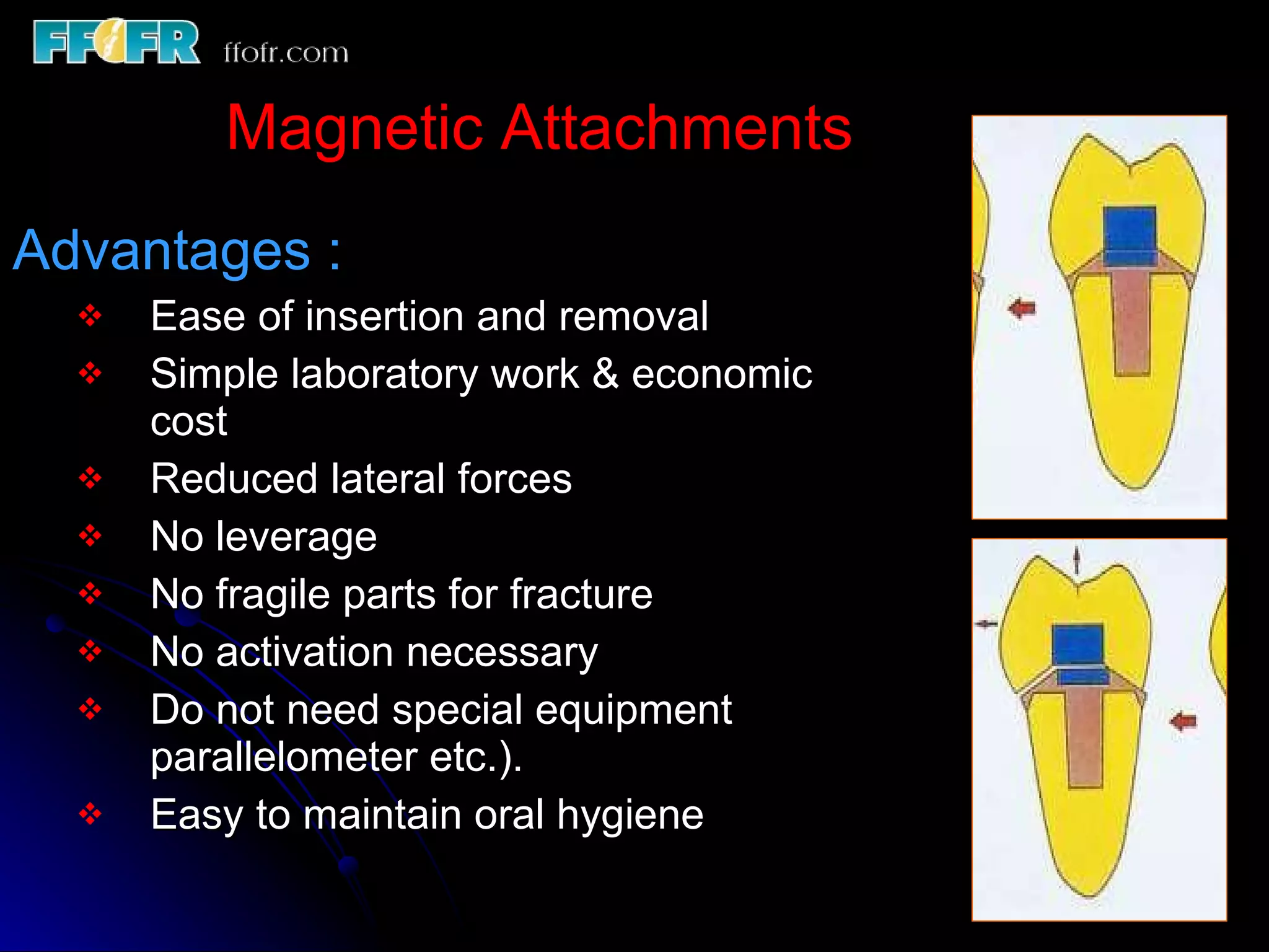 Esthetics, rotational path, attachments | PPT
