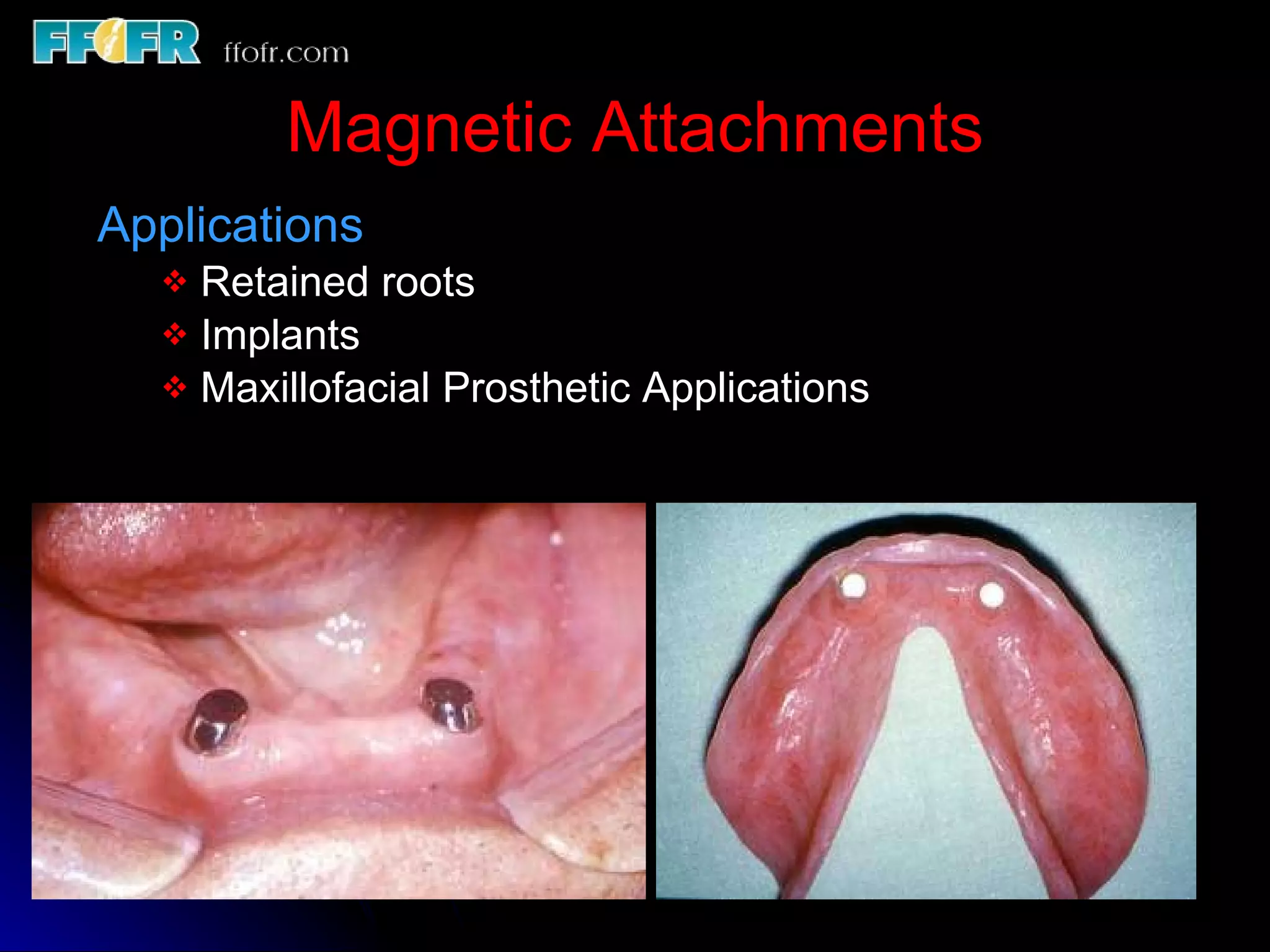 Esthetics, rotational path, attachments | PPT