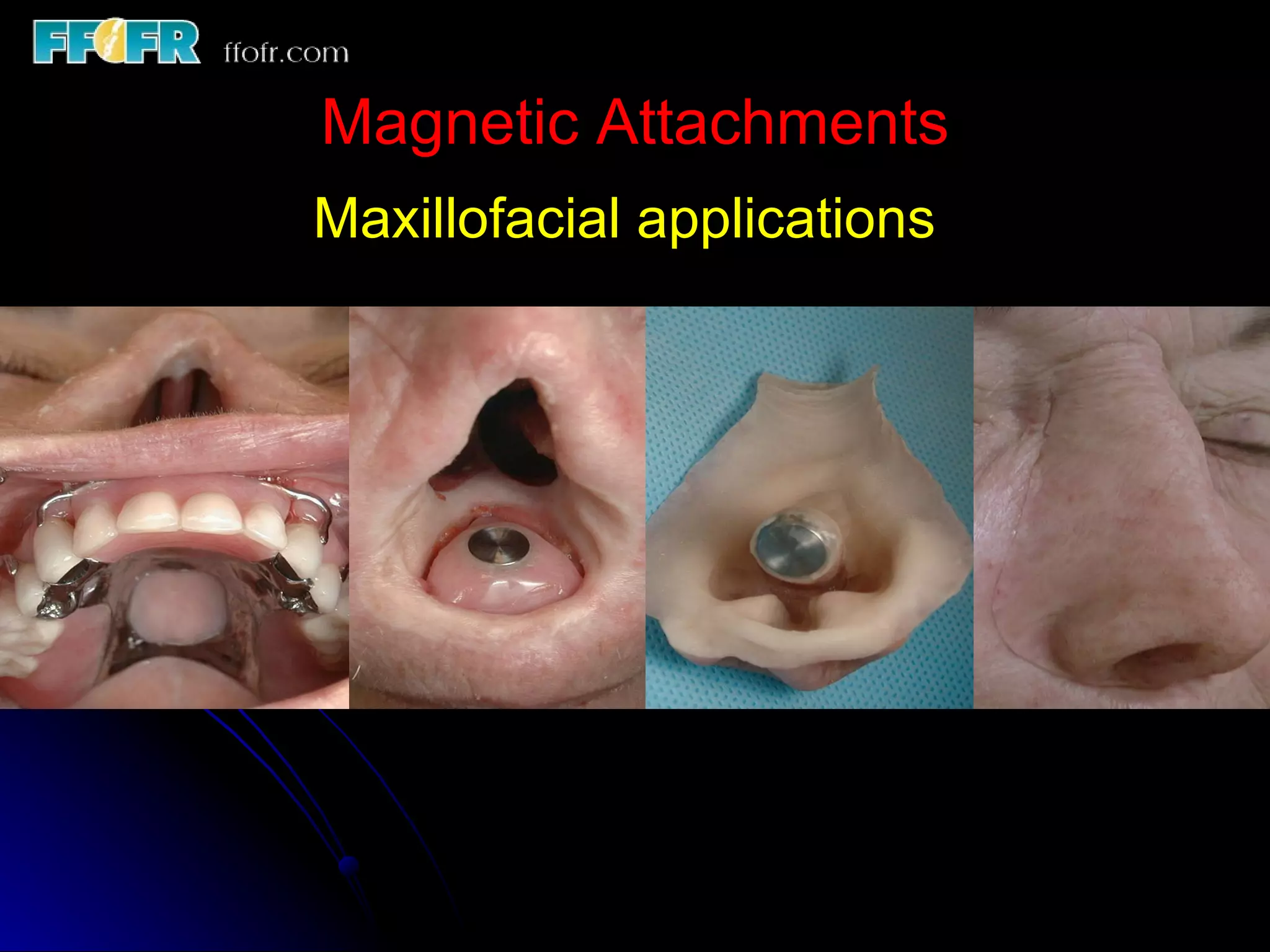 Esthetics, rotational path, attachments | PPT