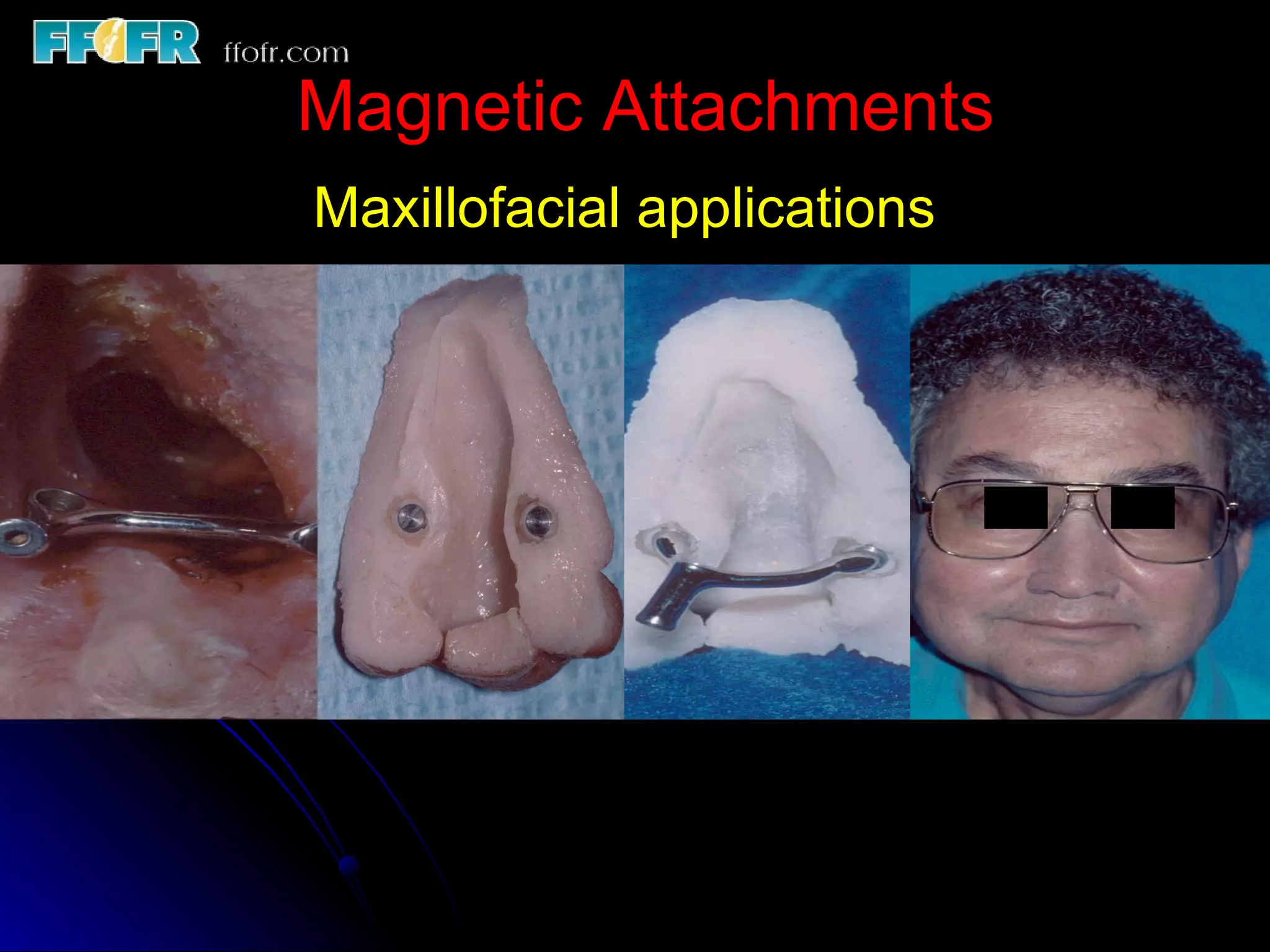Esthetics, rotational path, attachments | PPT