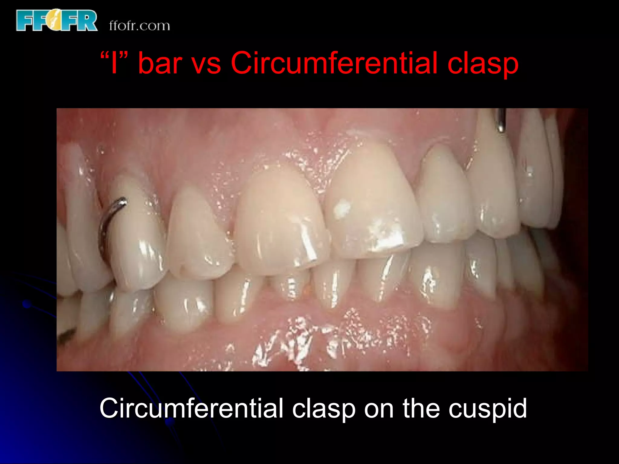 Esthetics, rotational path, attachments | PPT