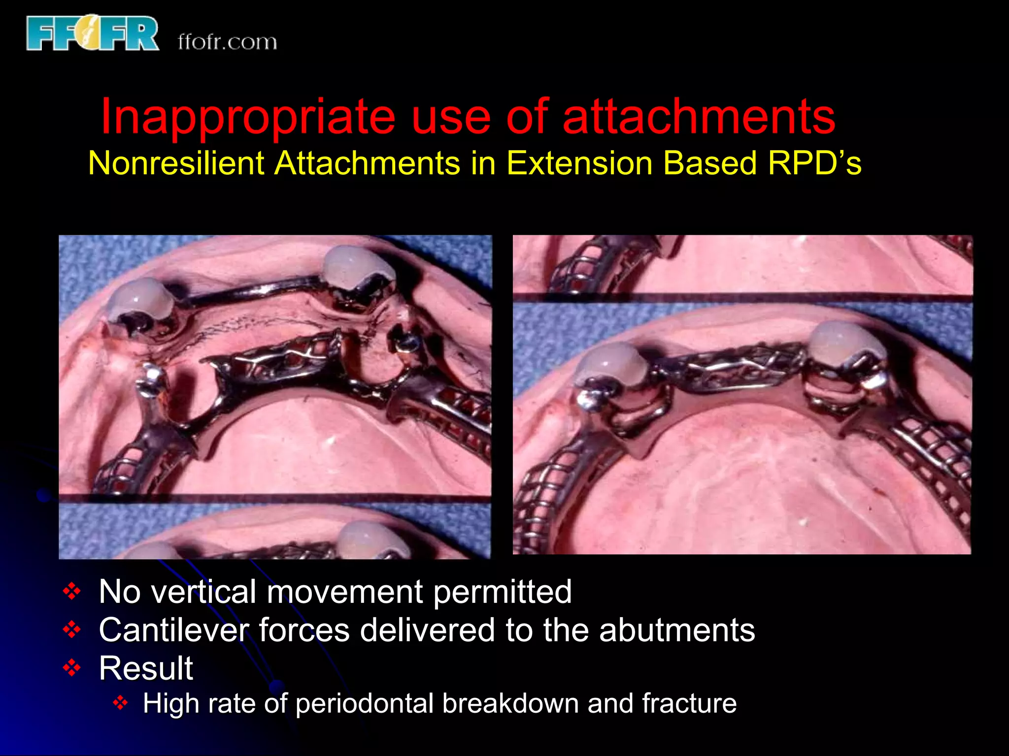 Esthetics, rotational path, attachments | PPT