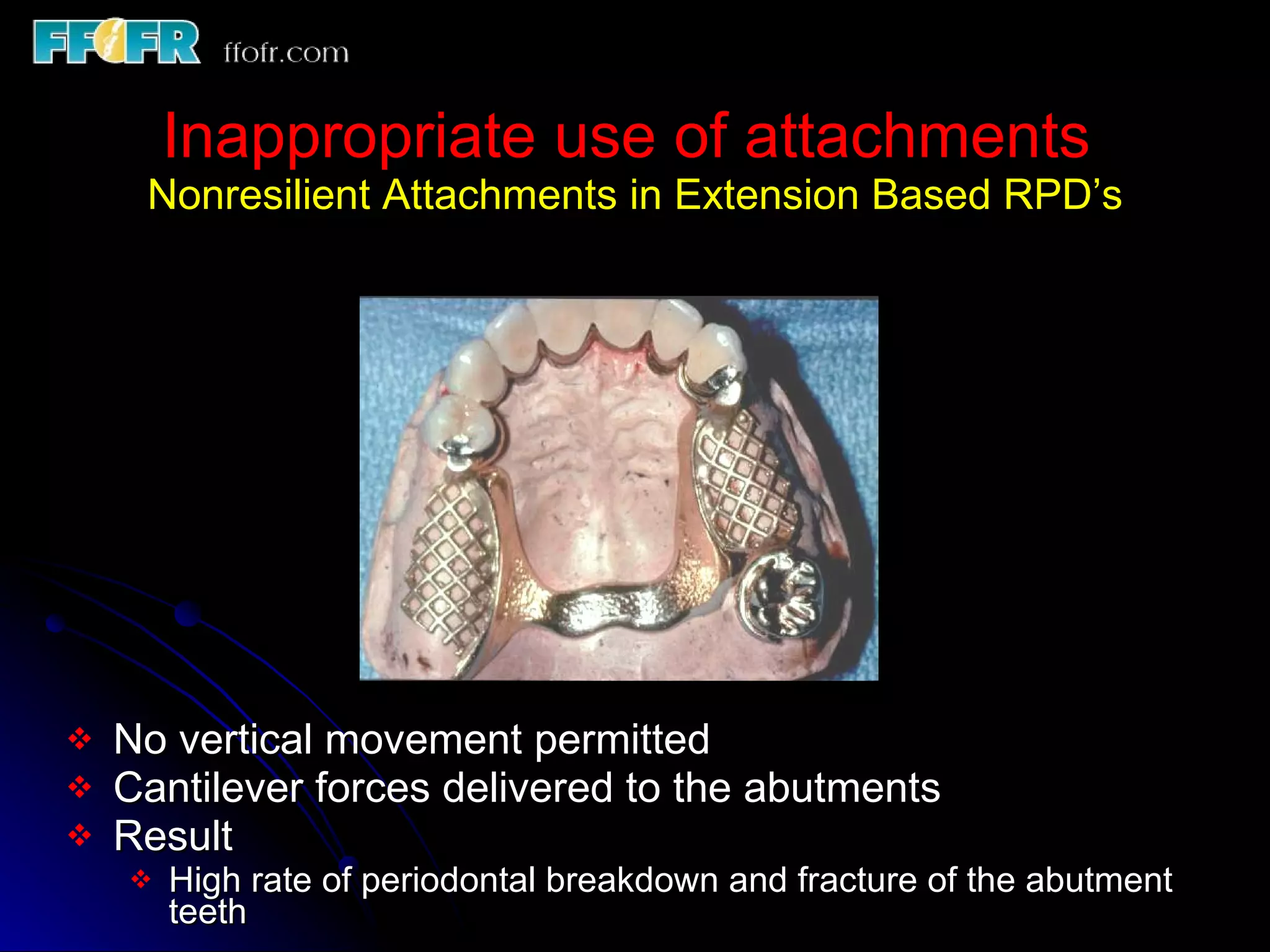 Esthetics, rotational path, attachments | PPT