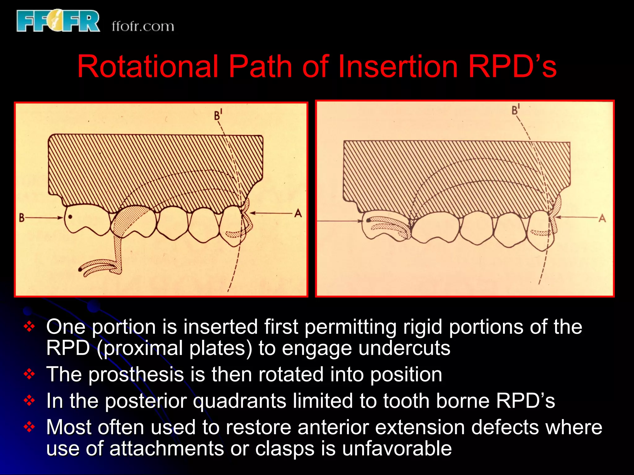 Esthetics, rotational path, attachments | PPT