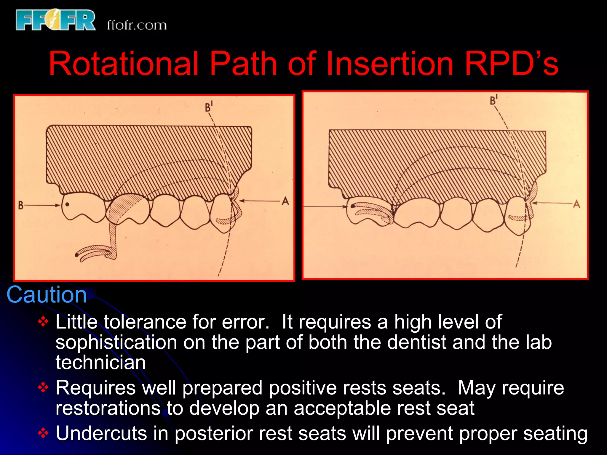 Esthetics, rotational path, attachments | PPT