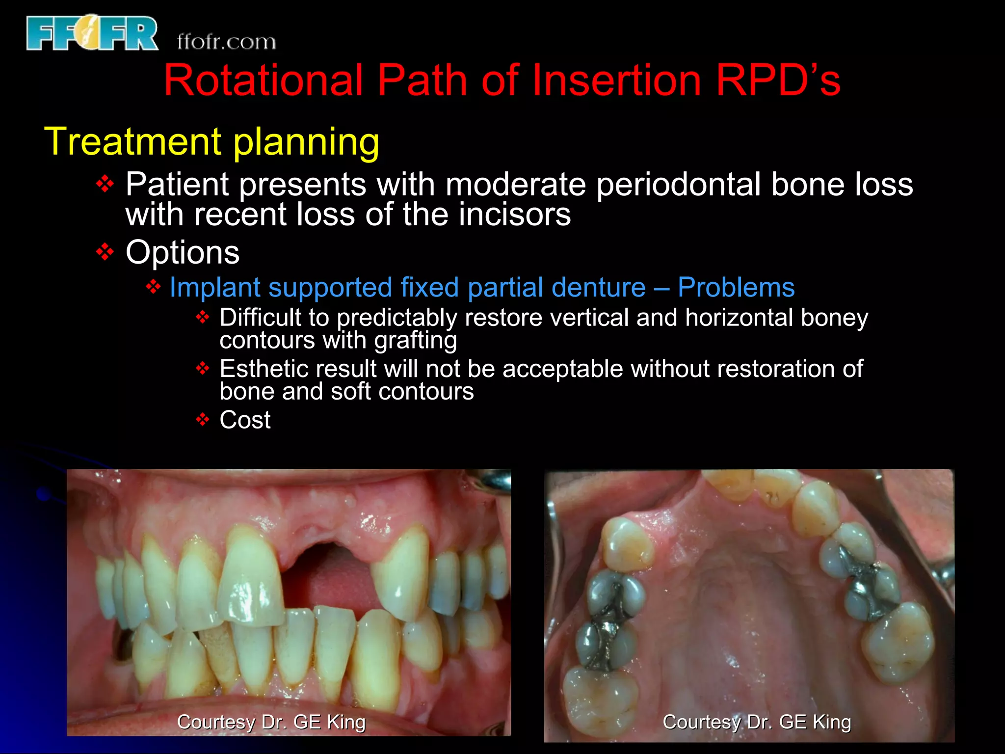 Esthetics, rotational path, attachments | PPT