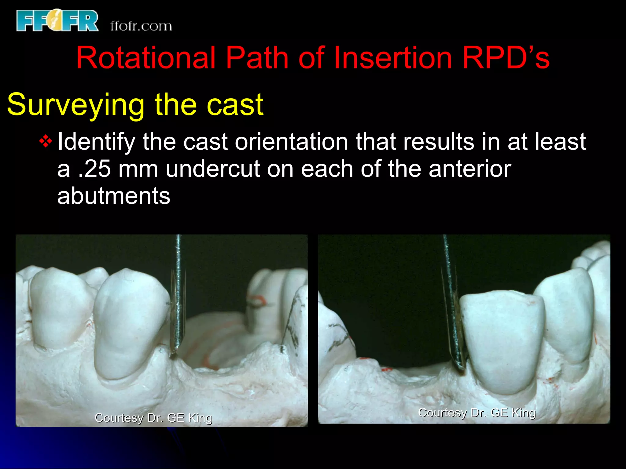 Esthetics, rotational path, attachments | PPT