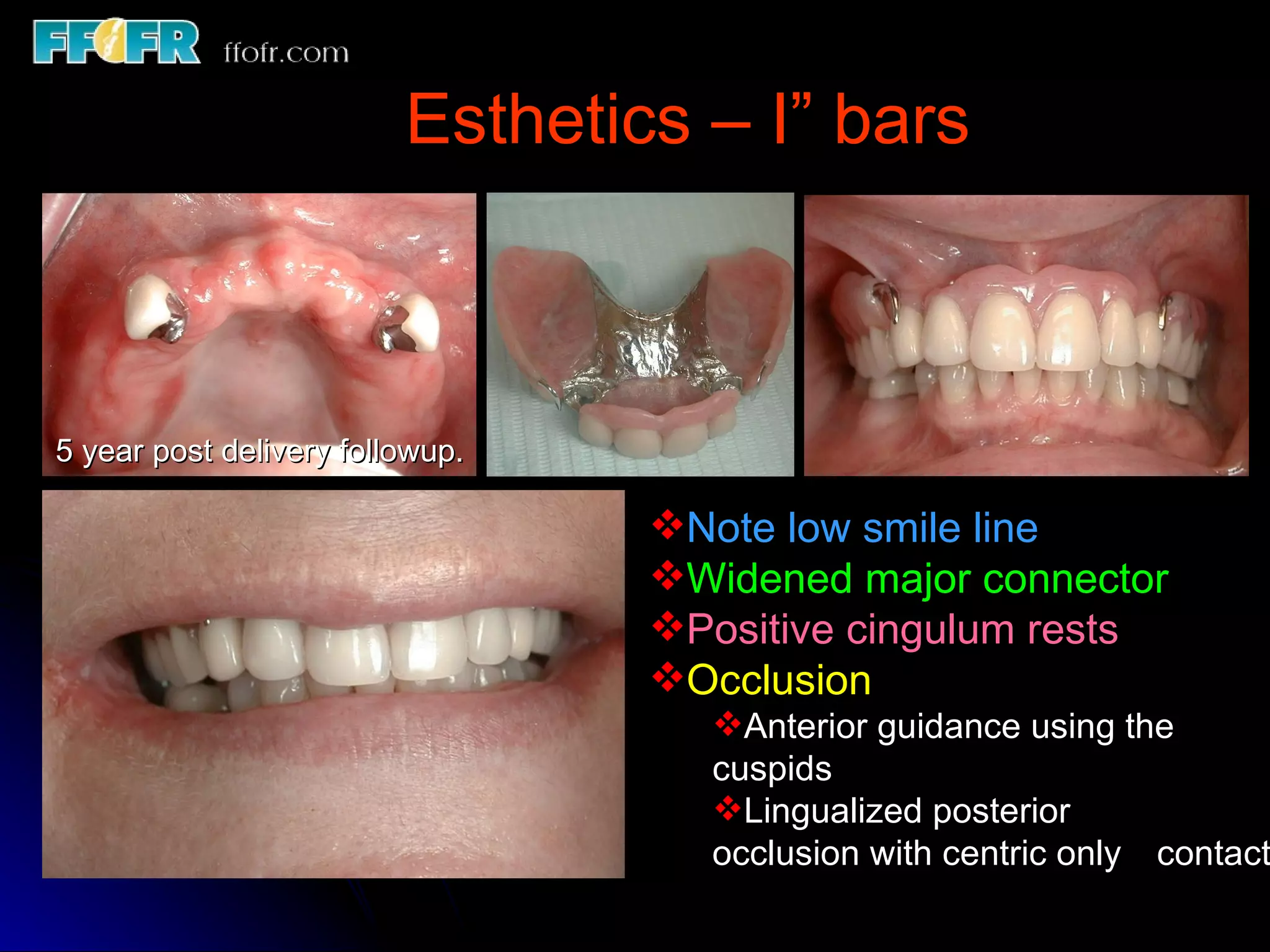 Esthetics, rotational path, attachments | PPT