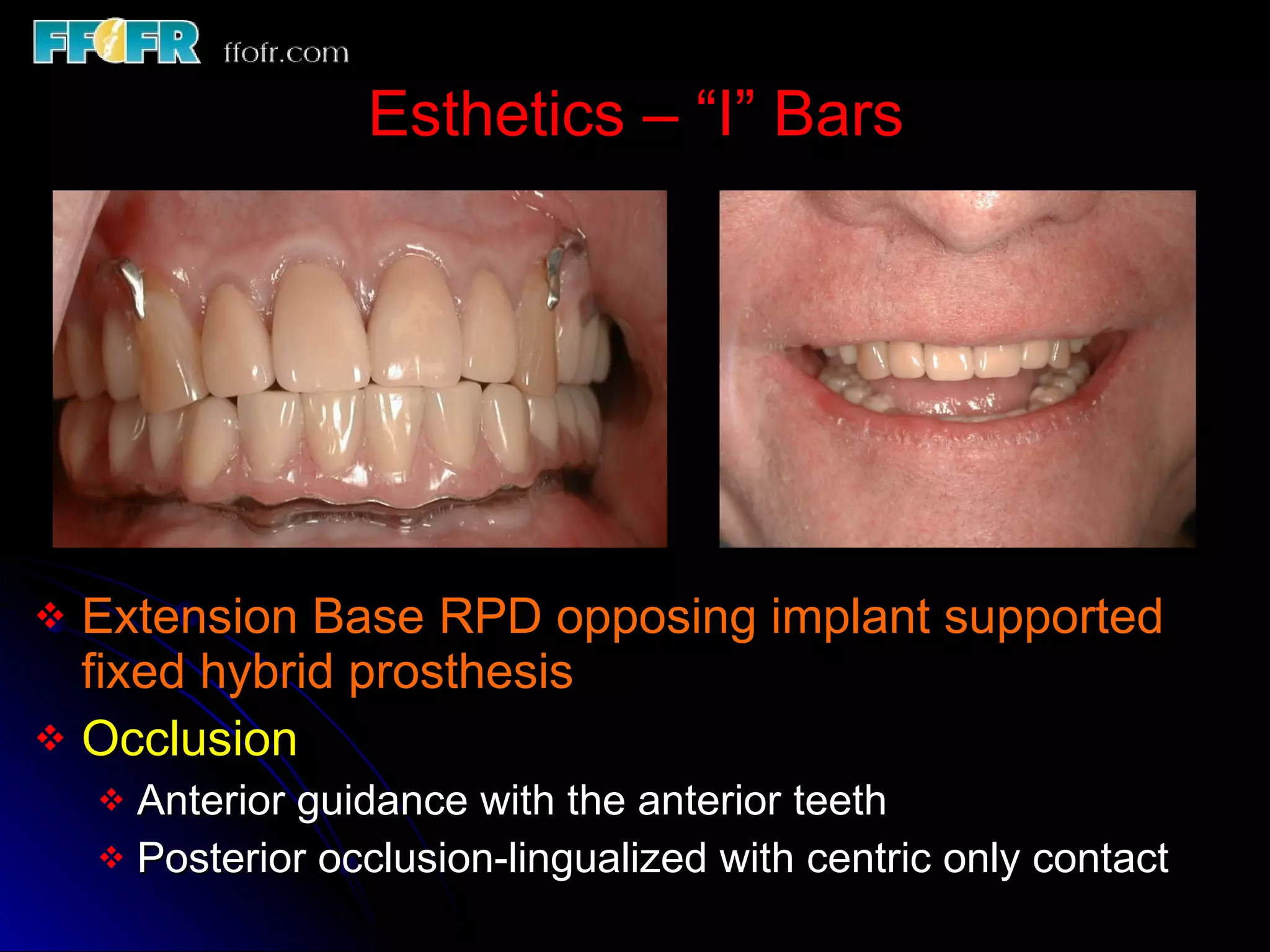 Esthetics, rotational path, attachments | PPT