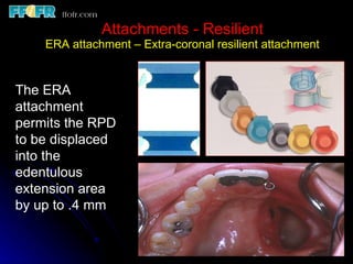 Esthetics, rotational path, attachments | PPT