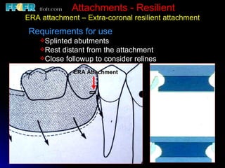 Esthetics, rotational path, attachments | PPT