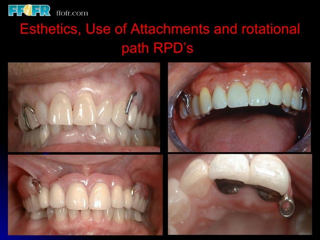 Esthetics, rotational path, attachments | PPT