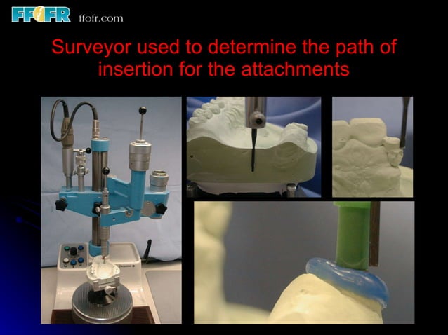Esthetics, rotational path, attachments | PPT
