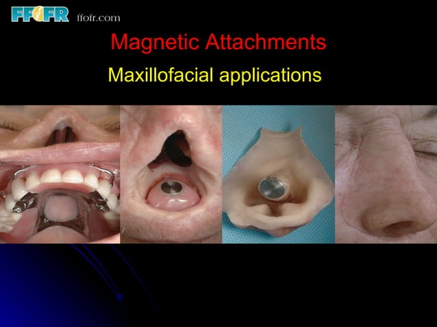 Esthetics, rotational path, attachments | PPT