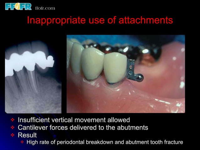 Esthetics, rotational path, attachments | PPT