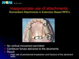 Esthetics, rotational path, attachments | PPT