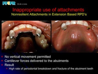 Esthetics, rotational path, attachments | PPT