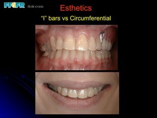 Esthetics, rotational path, attachments | PPT