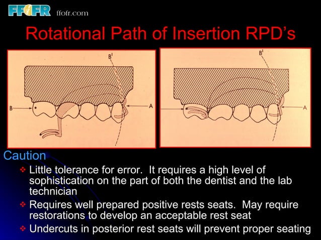 Esthetics, rotational path, attachments | PPT