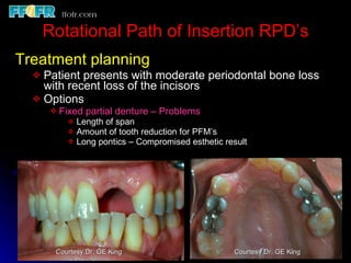 Esthetics, rotational path, attachments | PPT