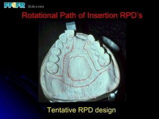 Esthetics, rotational path, attachments | PPT