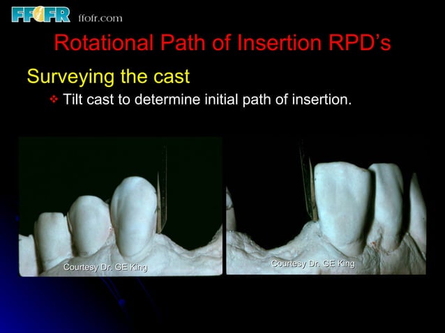Esthetics, rotational path, attachments | PPT