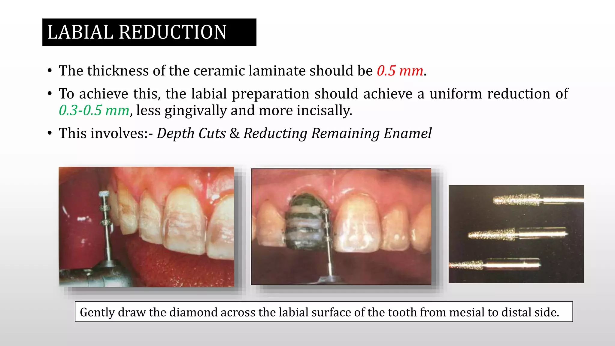 Laminates Veneers in Dentistry | PPTX