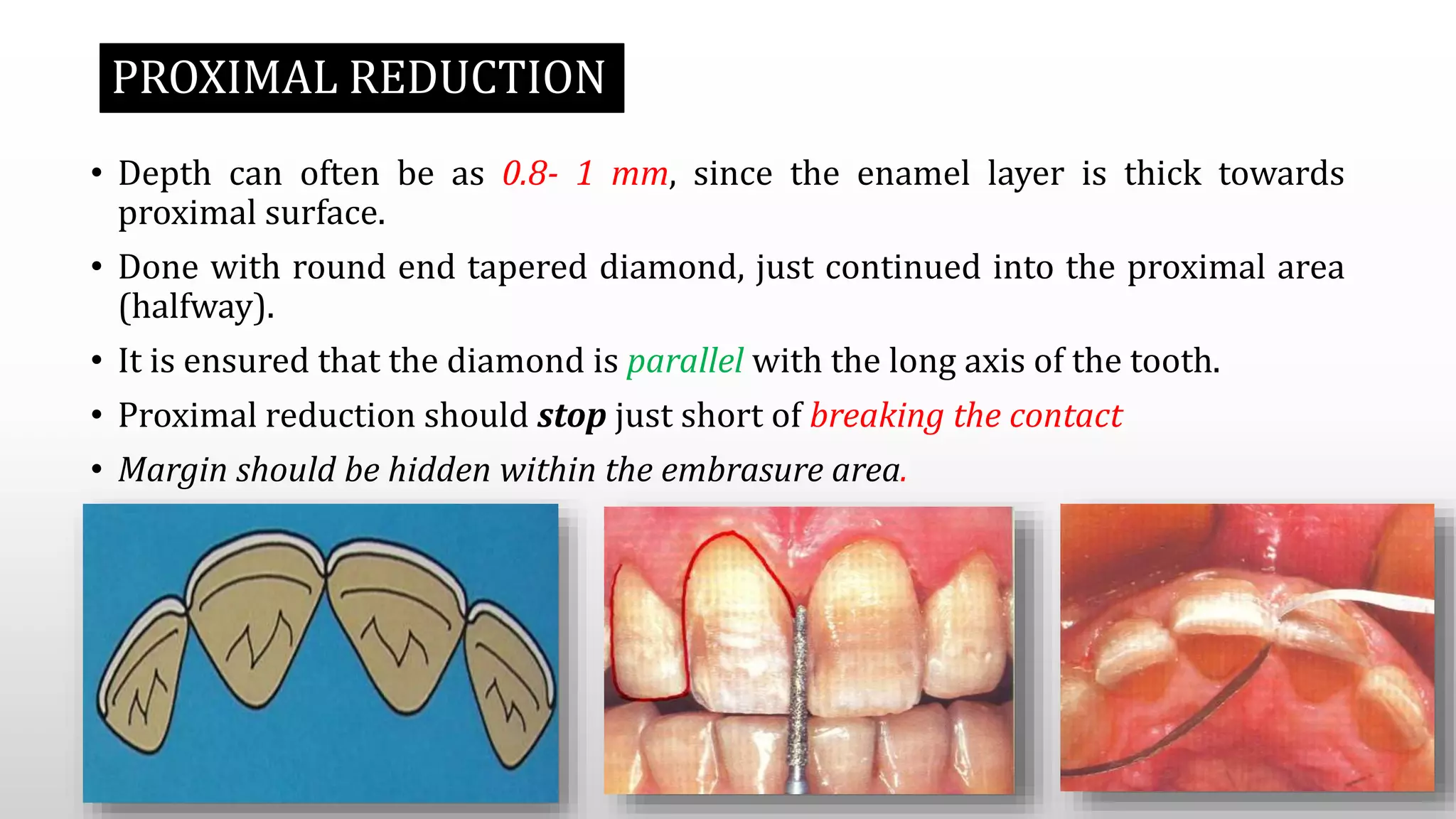 Laminates Veneers in Dentistry | PPTX