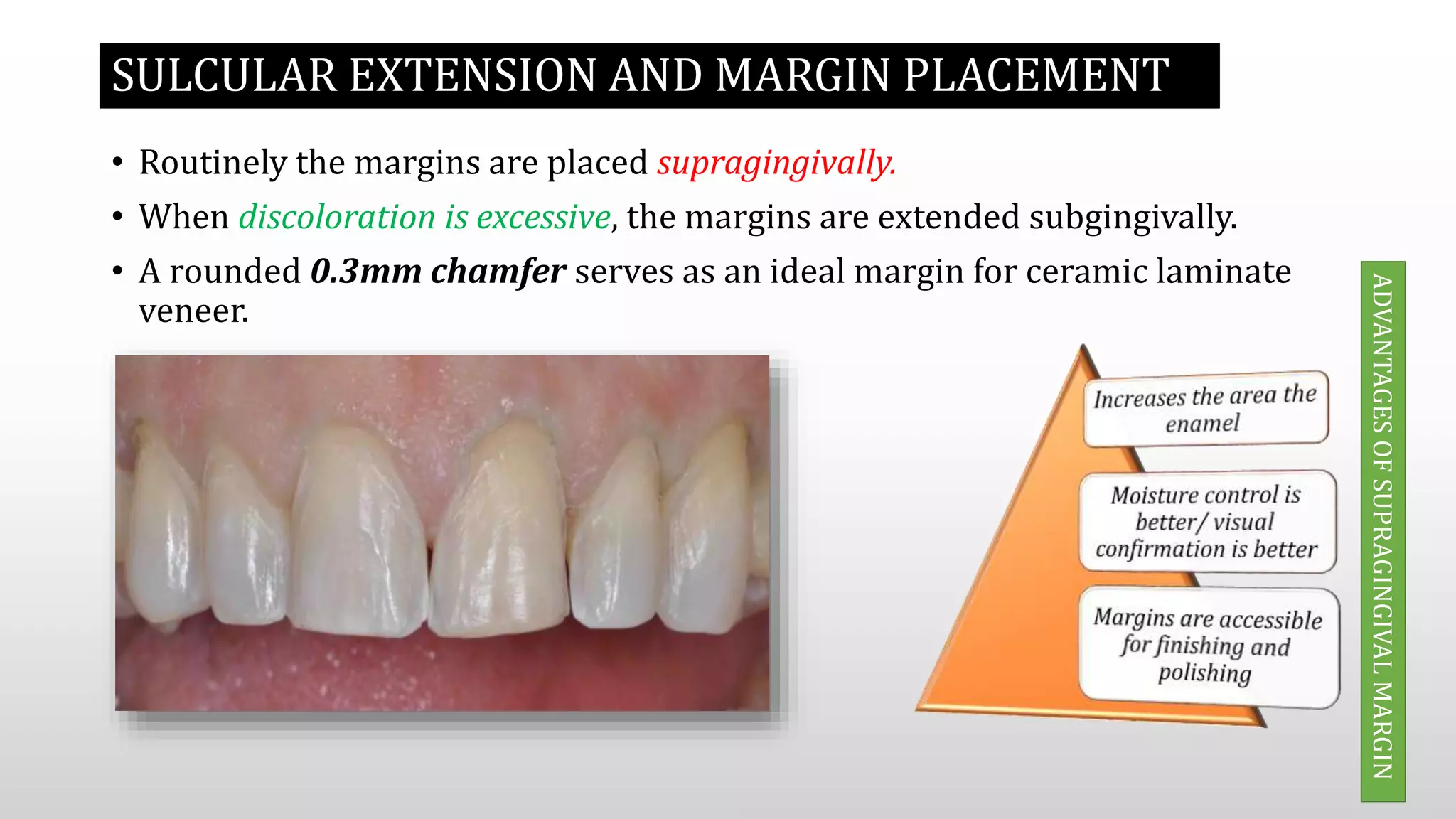 Laminates Veneers in Dentistry | PPTX