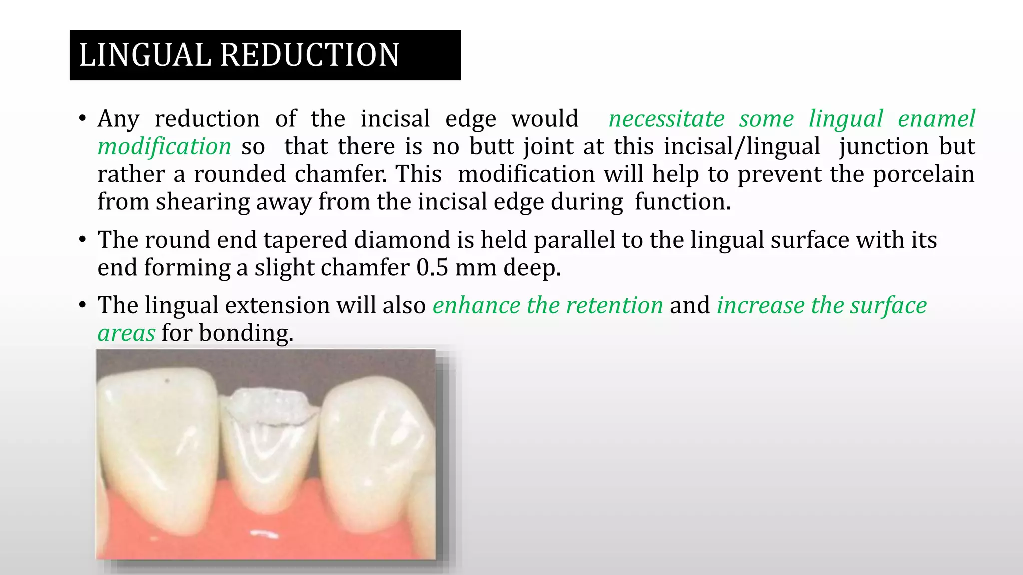 Laminates Veneers in Dentistry | PPTX