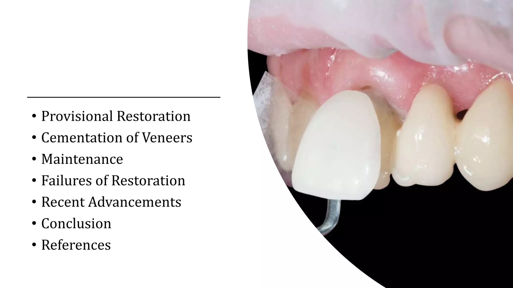 Laminates Veneers in Dentistry | PPTX