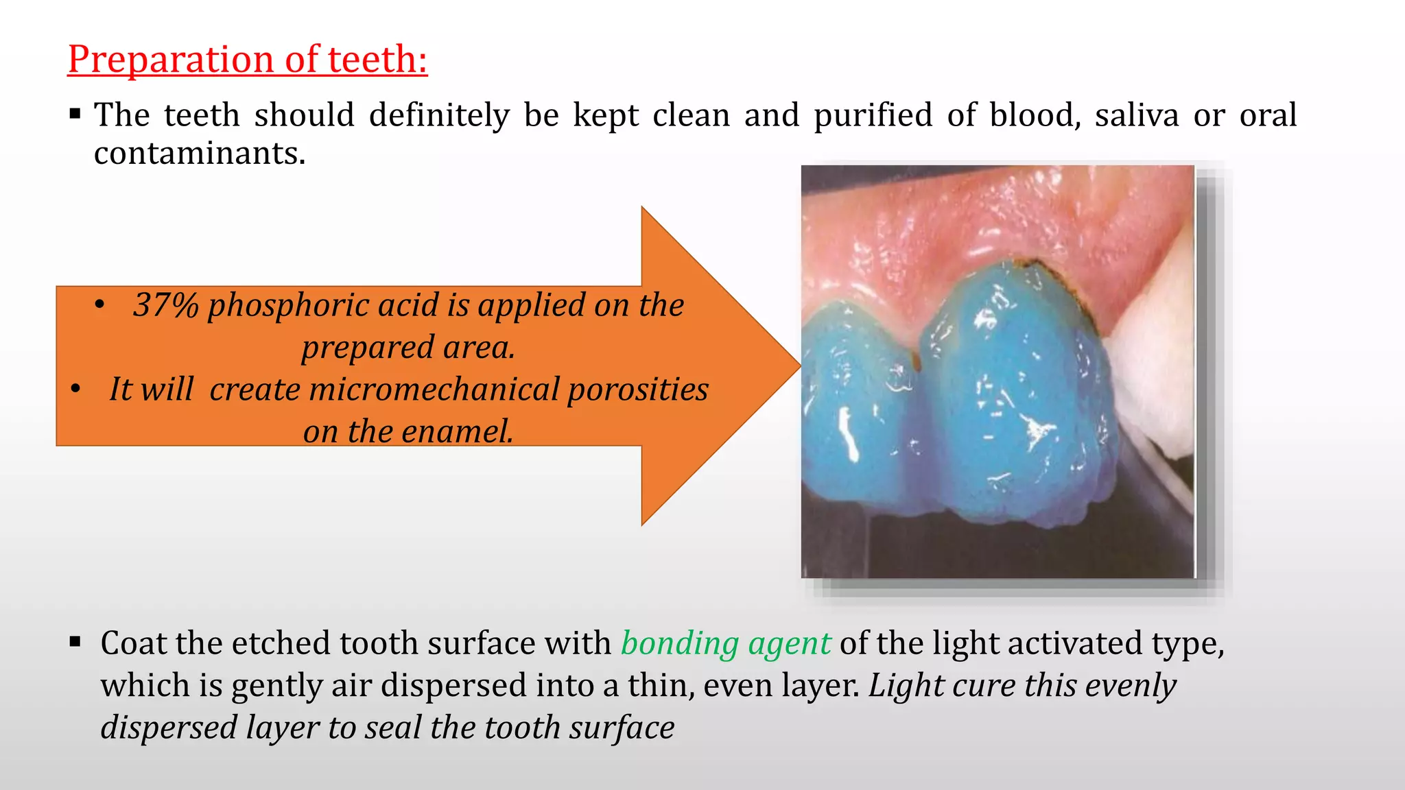 Laminates Veneers in Dentistry | PPTX